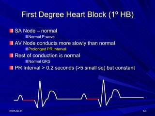 AV Nodal Blocks | PPT | Free Download