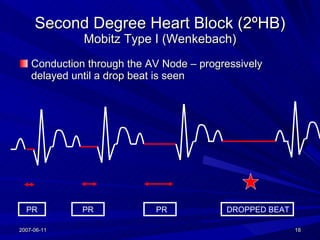 AV Nodal Blocks | PPT