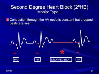 AV Nodal Blocks | PPT