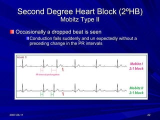 AV Nodal Blocks | PPT