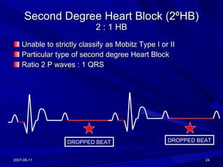AV Nodal Blocks | PPT