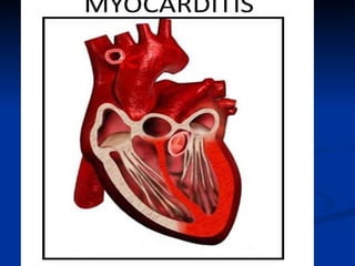 Miokarditis (Inflamasi pada Otot Jantung) | PPT