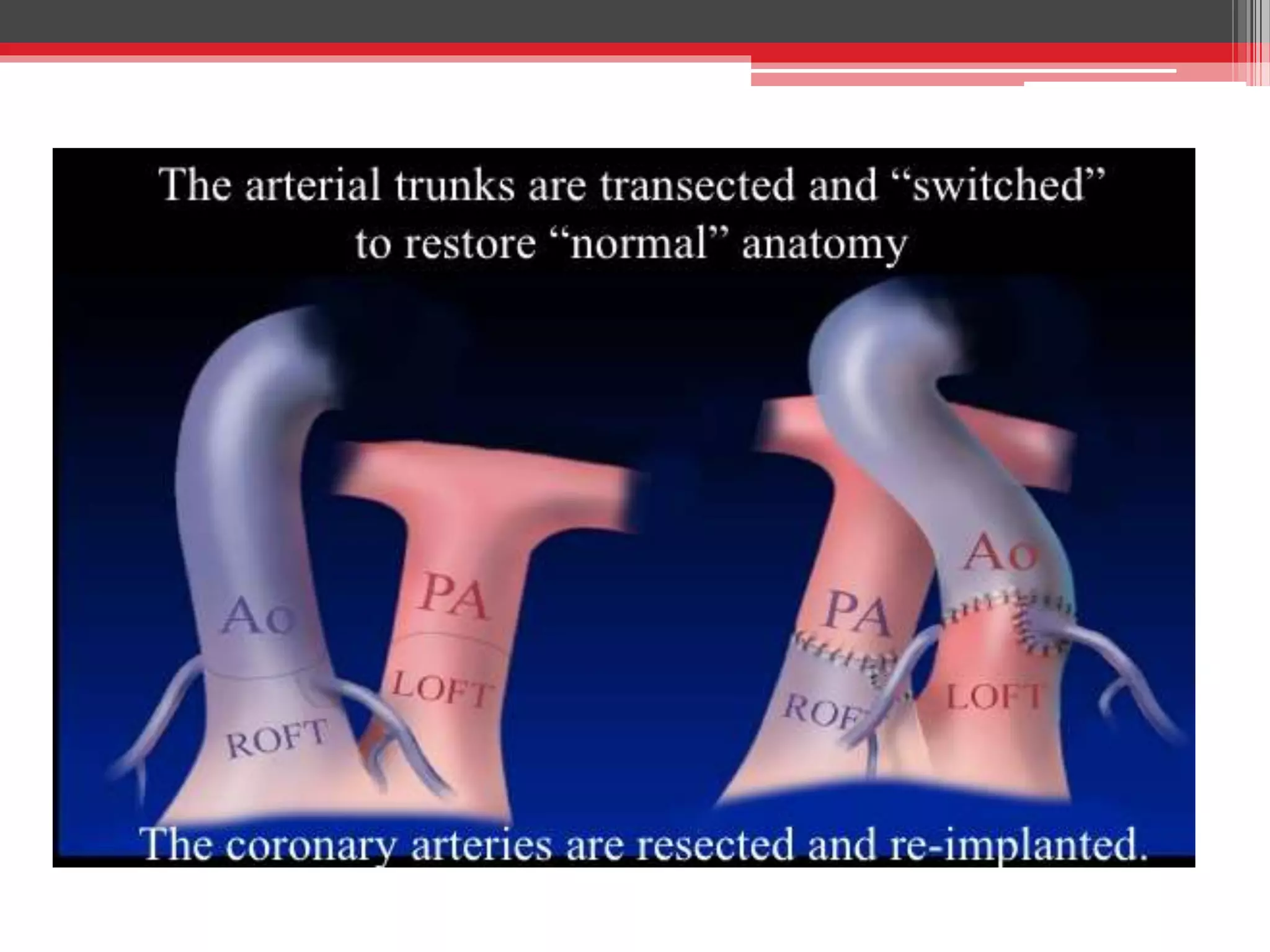 Congenital Heart Disorders (TOF, TGV, COA) | PPTX