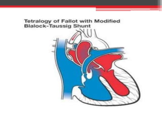 Congenital Heart Disorders (TOF, TGV, COA) | PPT