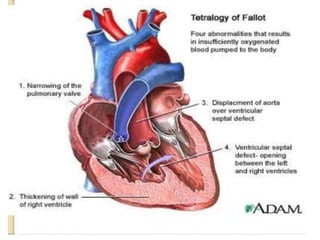 Congenital Heart Disorders (TOF, TGV, COA) | PPTX | Heart and ...