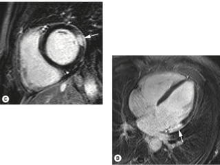 Imaging in Myocardial Infarction and Thallium Scan | PPTX