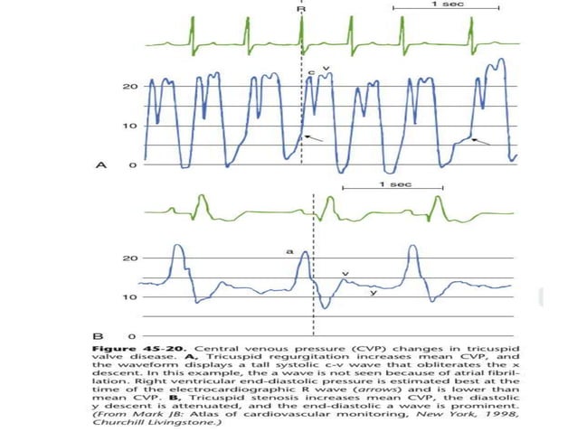Cardio Vascular Monitoring, Anesthesia | PPTX