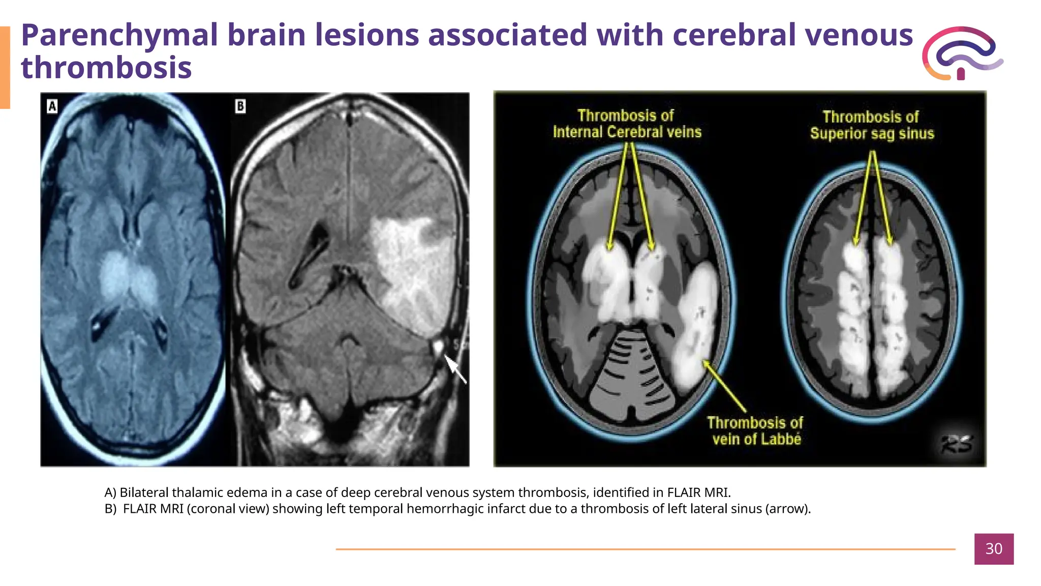 Cerebral venous sinus thrombosis : Clinical picture and management | PPTX