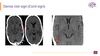 Cerebral venous sinus thrombosis : Clinical picture and management | PPTX
