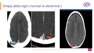 Cerebral venous sinus thrombosis : Clinical picture and management | PPTX