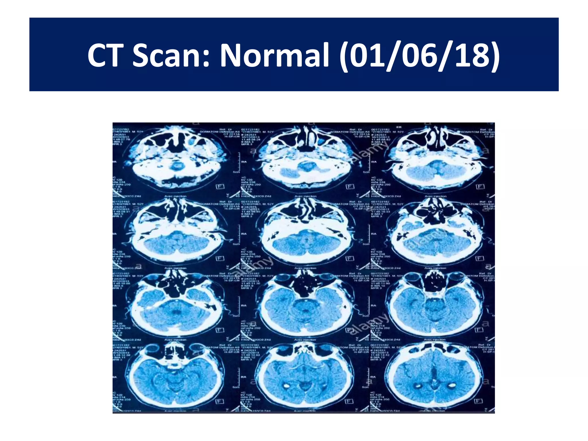 Cerebral Venous Sinus Thrombosis (CVST) Case Report | PPTX