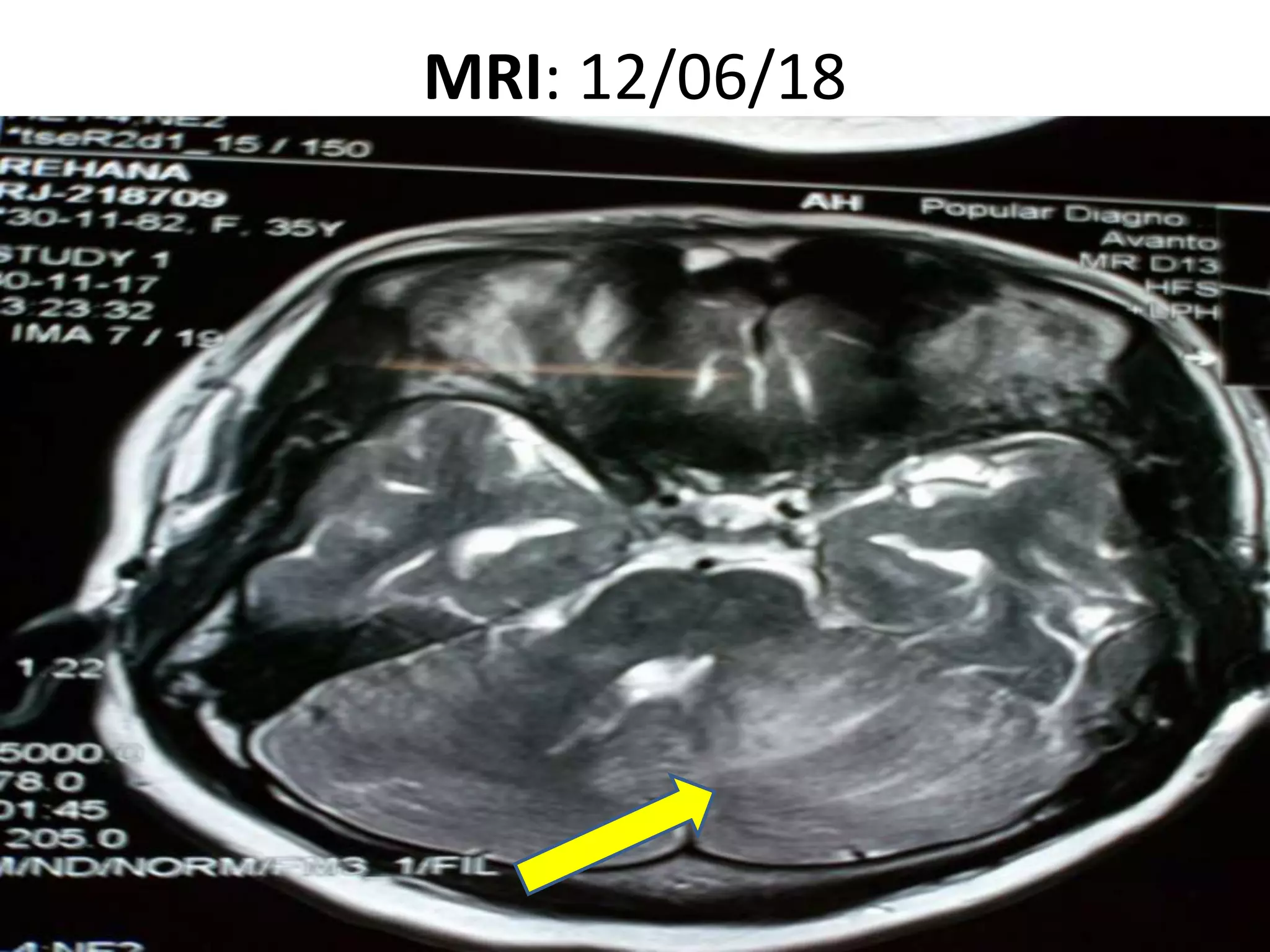 Cerebral Venous Sinus Thrombosis Cvst Case Report Ppt