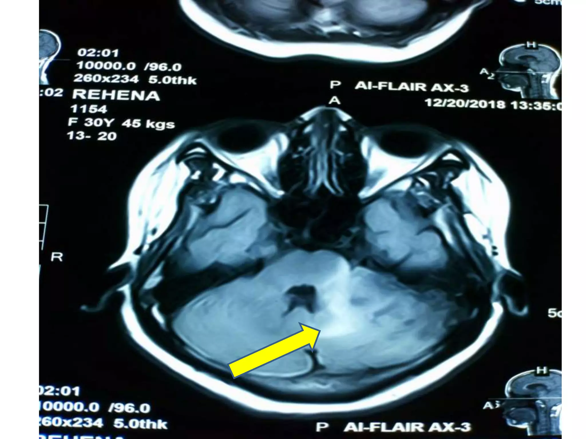 Cerebral Venous Sinus Thrombosis Cvst Case Report Ppt