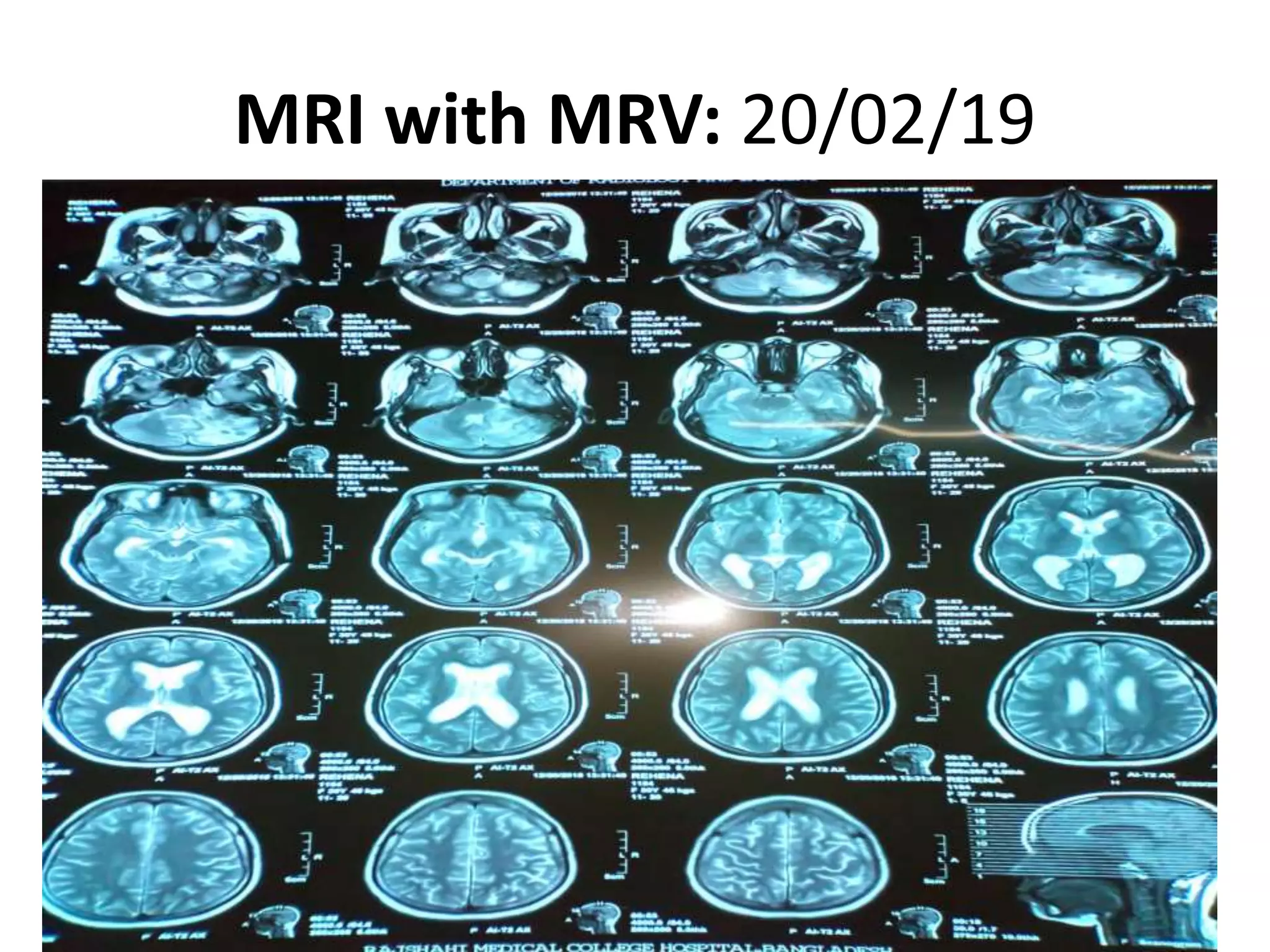 Cerebral Venous Sinus Thrombosis (CVST) Case Report | PPTX