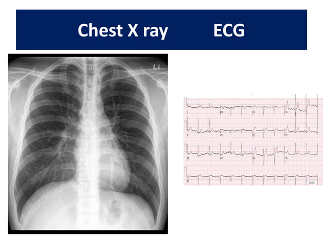 Cerebral Venous Sinus Thrombosis (CVST) Case Report | PPTX | Ear, Nose ...