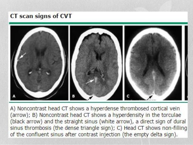 CEREBRAL VENOUS THROMBOSIS