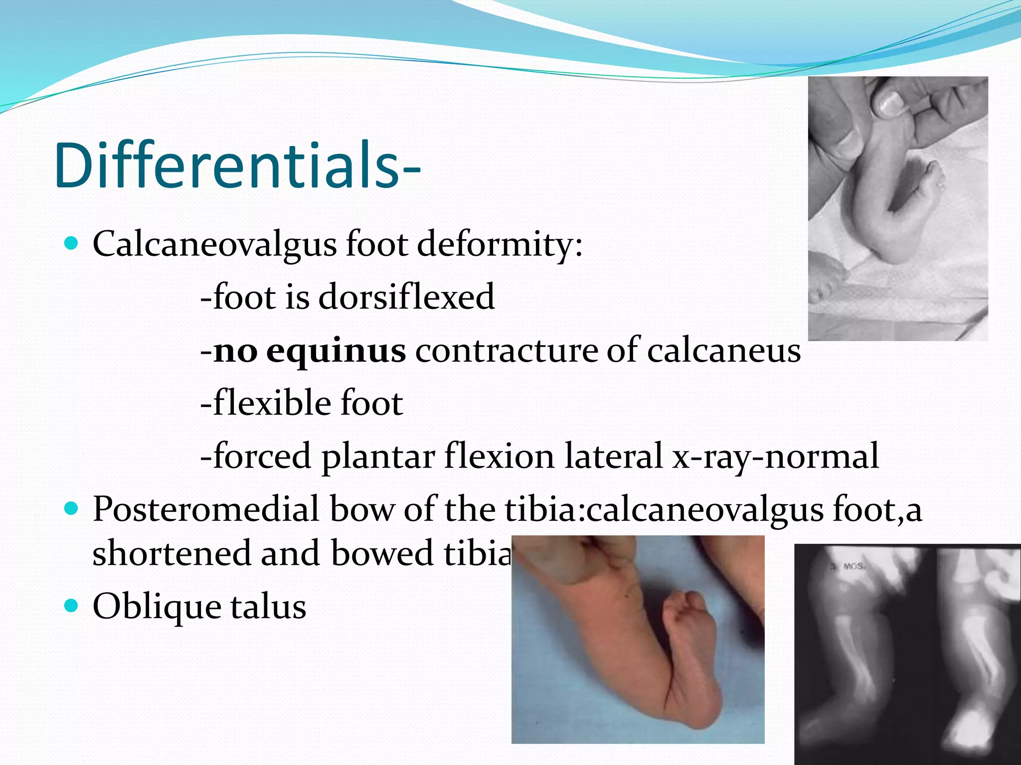 Congenital vertical talus | PPTX