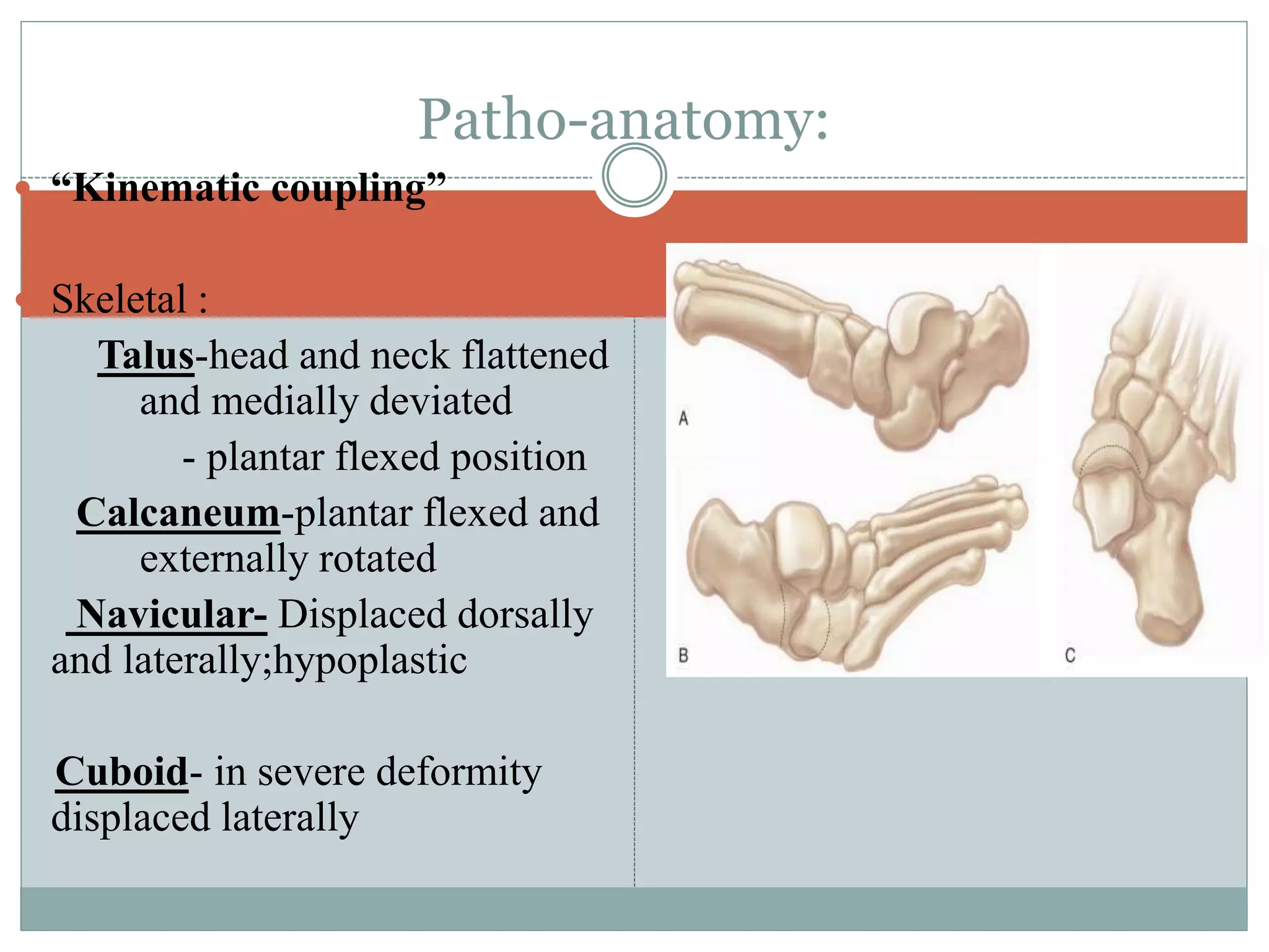 Congenital vertical talus BY DR.NAVEEN RATHOR | PPTX