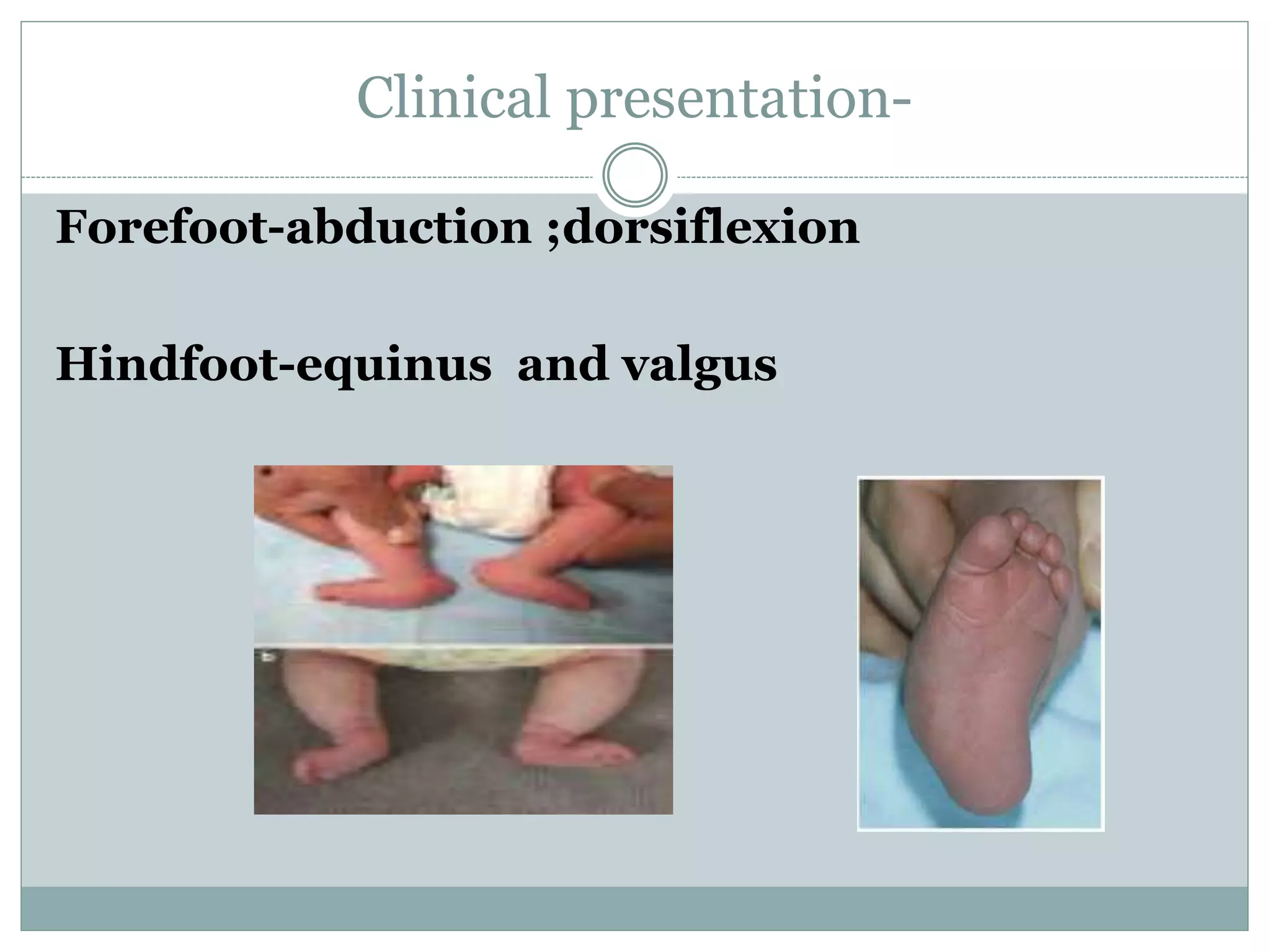 Congenital vertical talus BY DR.NAVEEN RATHOR | PPTX