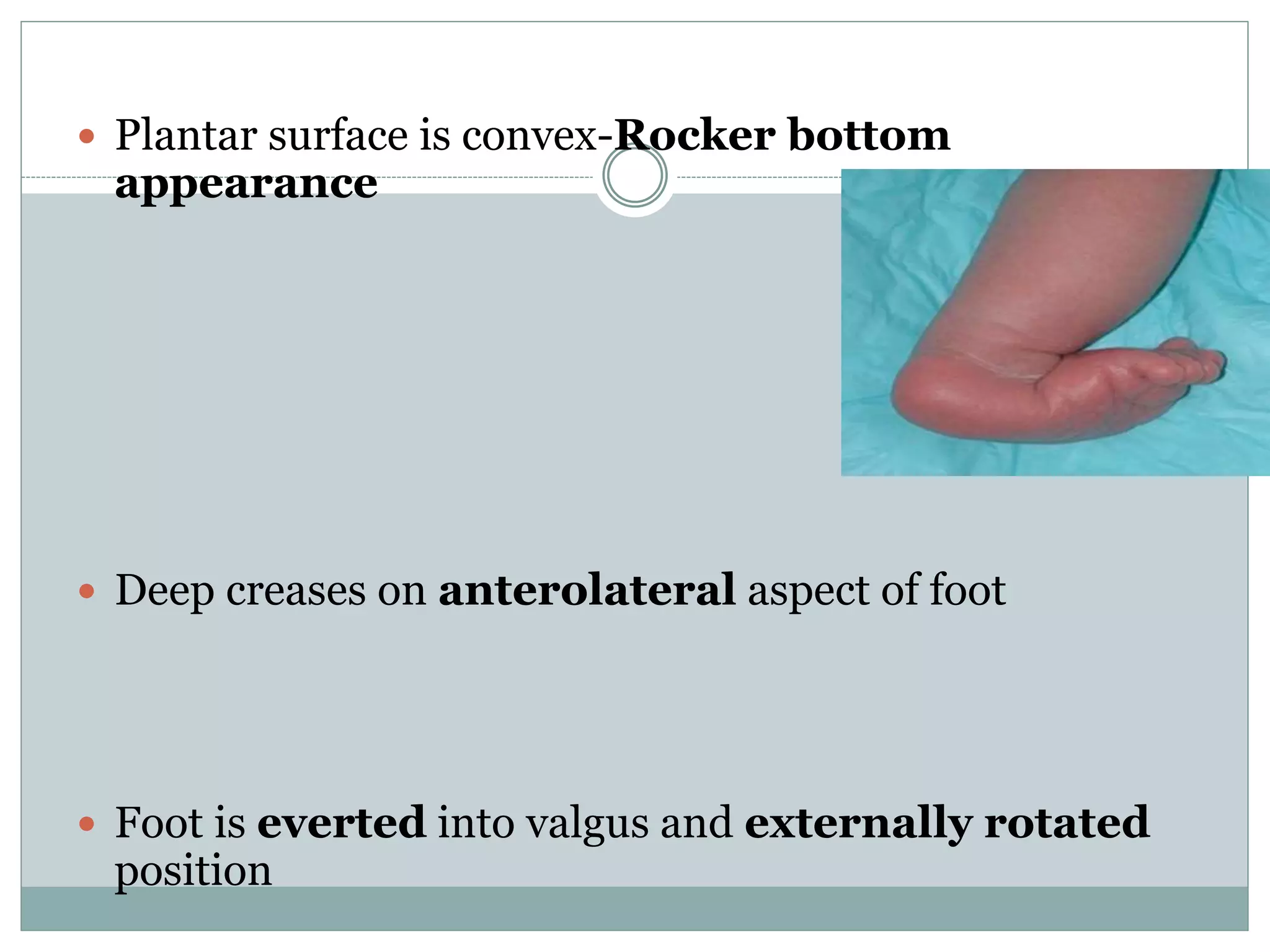 Congenital vertical talus BY DR.NAVEEN RATHOR | PPTX