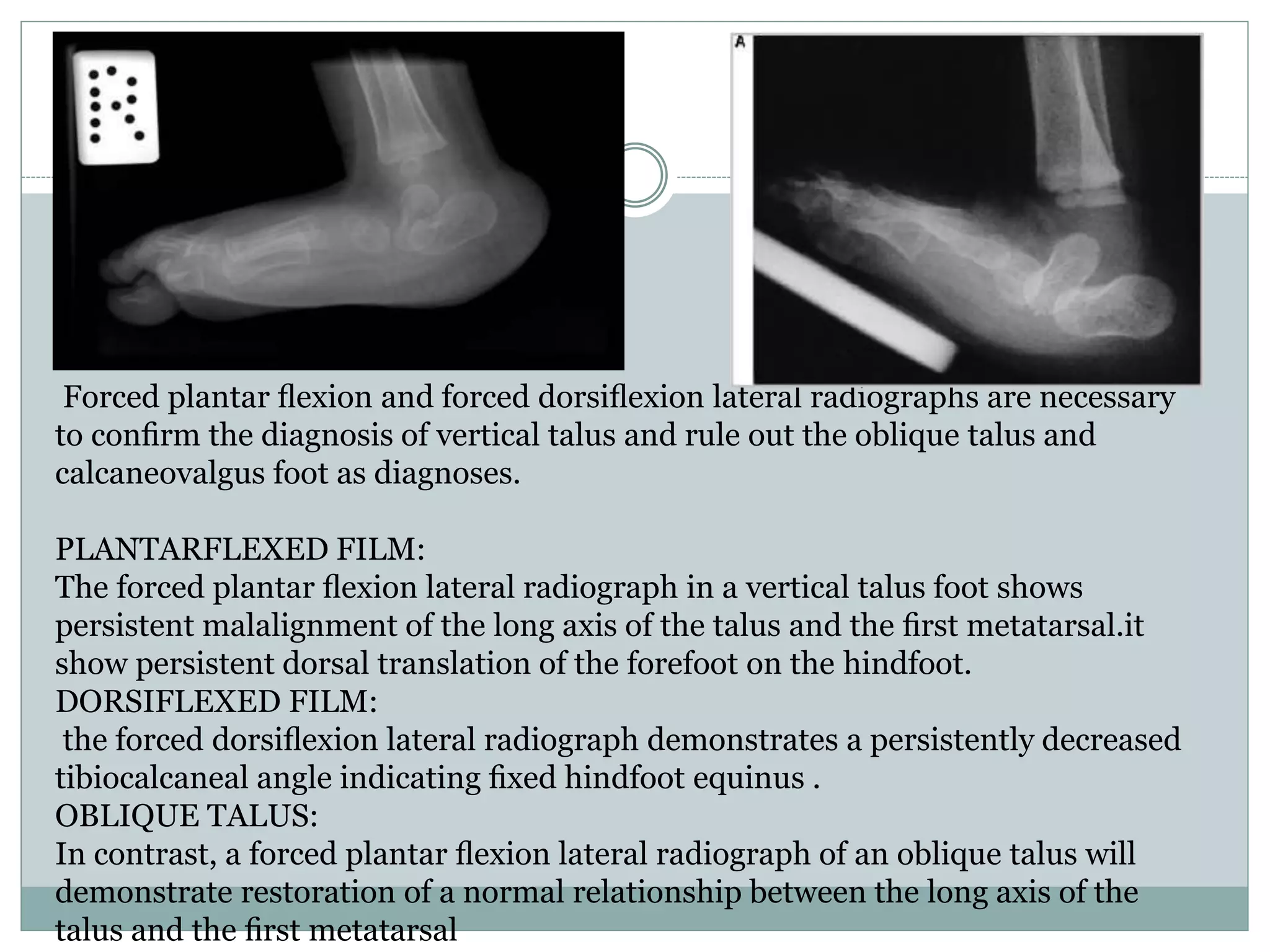 Congenital vertical talus BY DR.NAVEEN RATHOR | PPTX