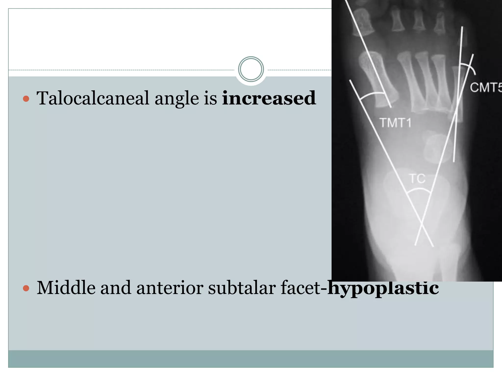 Congenital vertical talus BY DR.NAVEEN RATHOR | PPTX