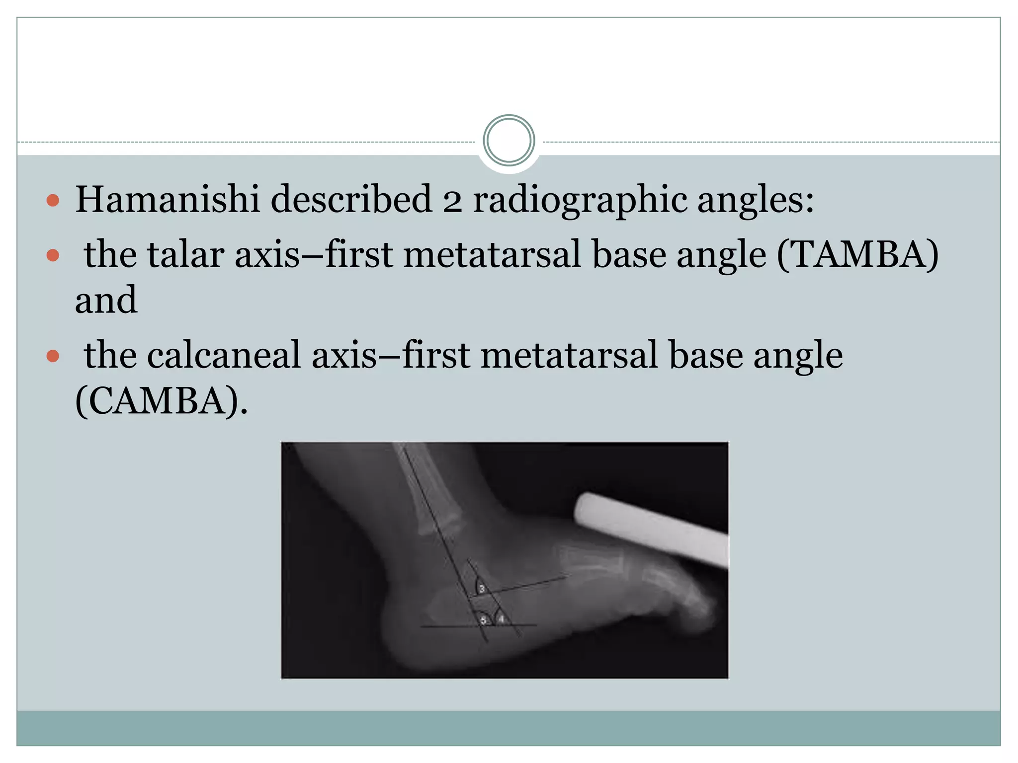 Congenital vertical talus BY DR.NAVEEN RATHOR | PPTX