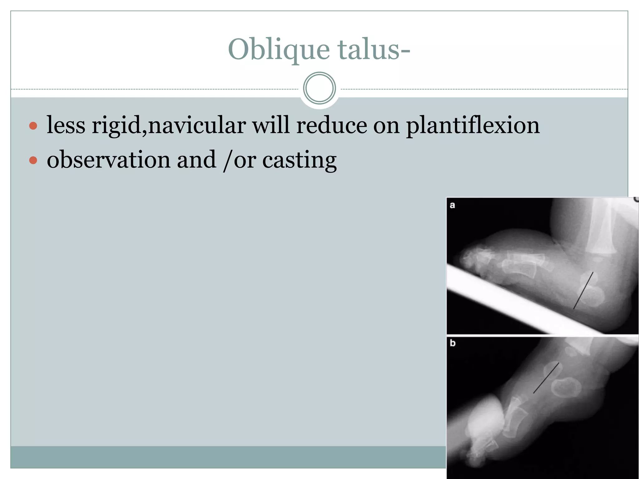 Congenital vertical talus BY DR.NAVEEN RATHOR | PPTX