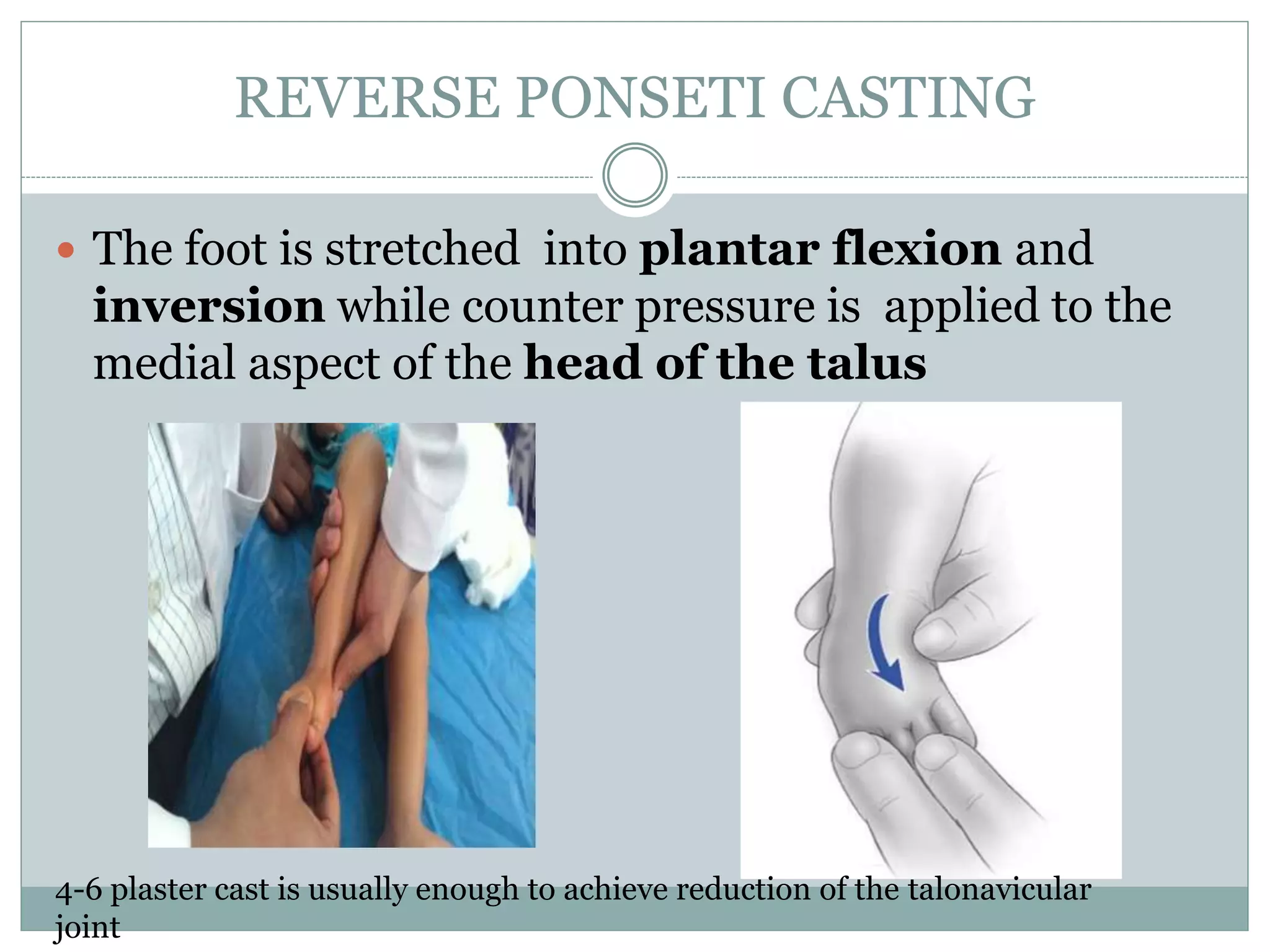 Congenital vertical talus BY DR.NAVEEN RATHOR | PPTX