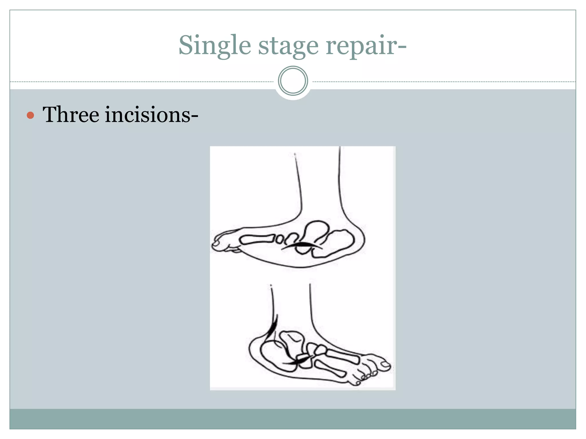 Congenital vertical talus BY DR.NAVEEN RATHOR | PPTX