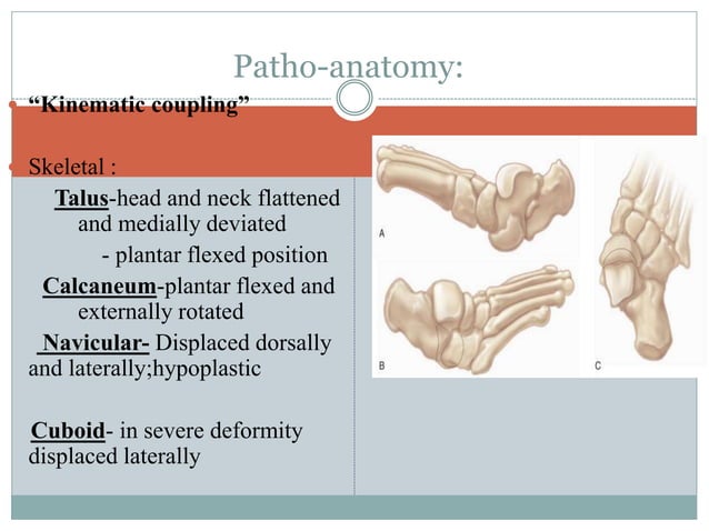 Congenital vertical talus BY DR.NAVEEN RATHOR | PPTX