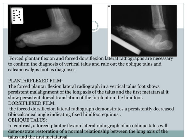 Congenital vertical talus BY DR.NAVEEN RATHOR | PPTX