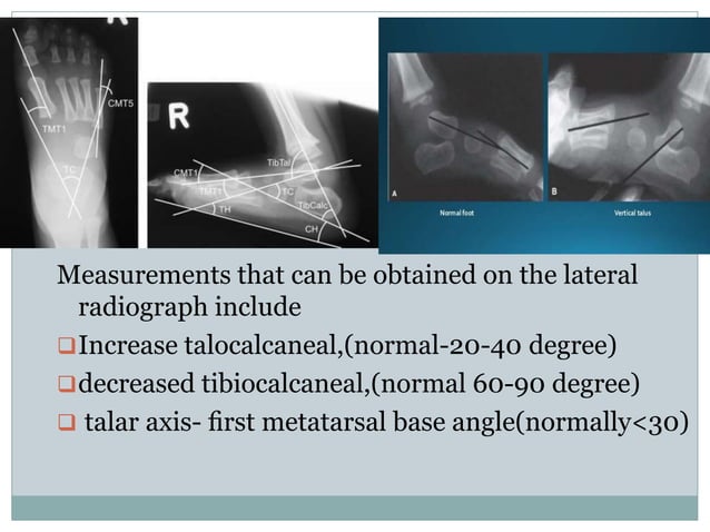 Congenital vertical talus BY DR.NAVEEN RATHOR | PPTX
