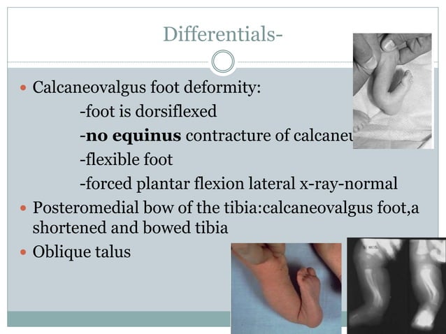 Congenital vertical talus BY DR.NAVEEN RATHOR | PPTX