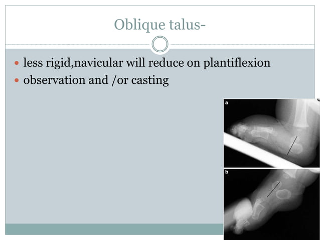 Congenital vertical talus BY DR.NAVEEN RATHOR | PPTX