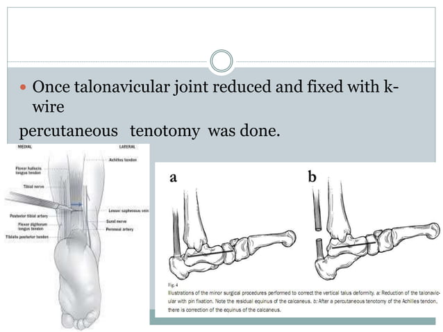 Congenital vertical talus BY DR.NAVEEN RATHOR | PPTX