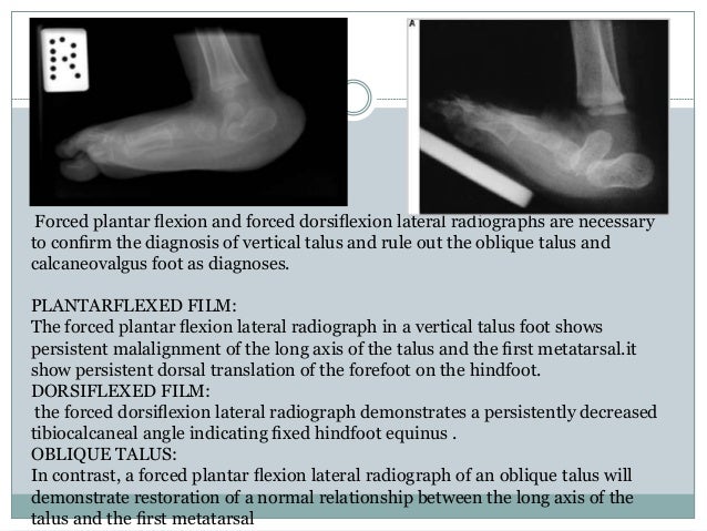 Congenital Vertical Talus By Dr Naveen Rathor