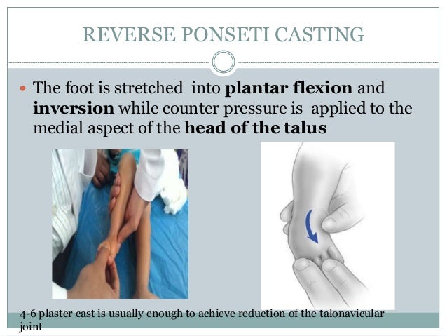 Congenital vertical talus BY DR.NAVEEN RATHOR