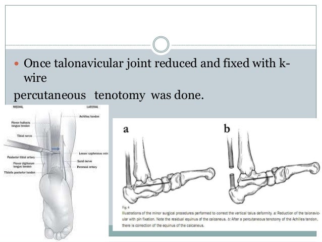 Congenital vertical talus BY DR.NAVEEN RATHOR