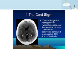 Cvt | PPT
