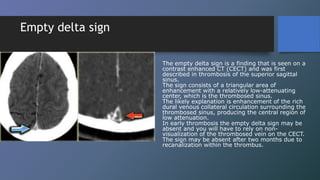 Cerebral Venous Thrombosis - Dr. KEO VEASNA | PPT