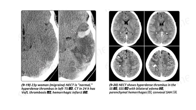 cerebral venous sinus thrombosis CNS.pptx