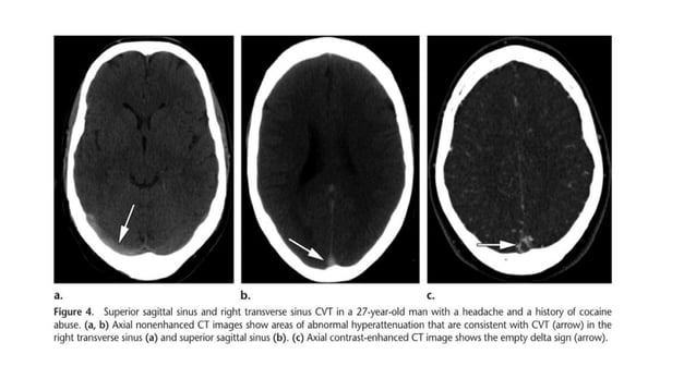 cerebral venous sinus thrombosis CNS.pptx