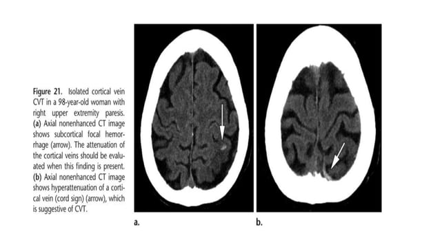 cerebral venous sinus thrombosis CNS.pptx