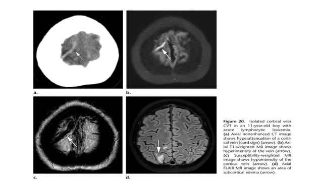 cerebral venous sinus thrombosis CNS.pptx