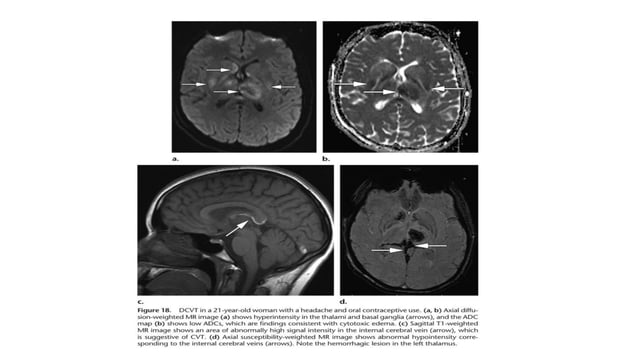 cerebral venous sinus thrombosis CNS.pptx