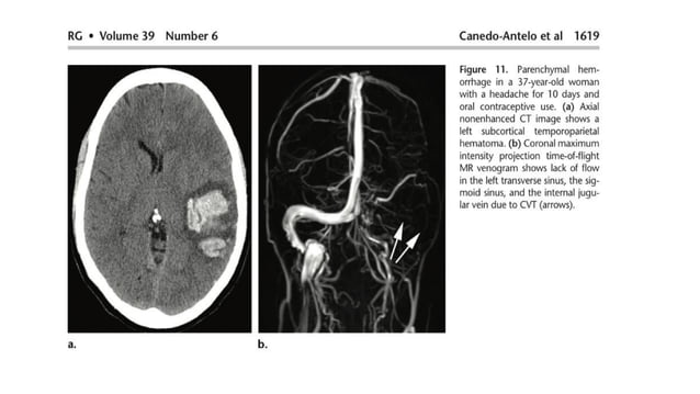 cerebral venous sinus thrombosis CNS.pptx