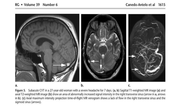 cerebral venous sinus thrombosis CNS.pptx