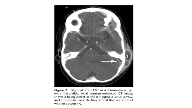 cerebral venous sinus thrombosis CNS.pptx