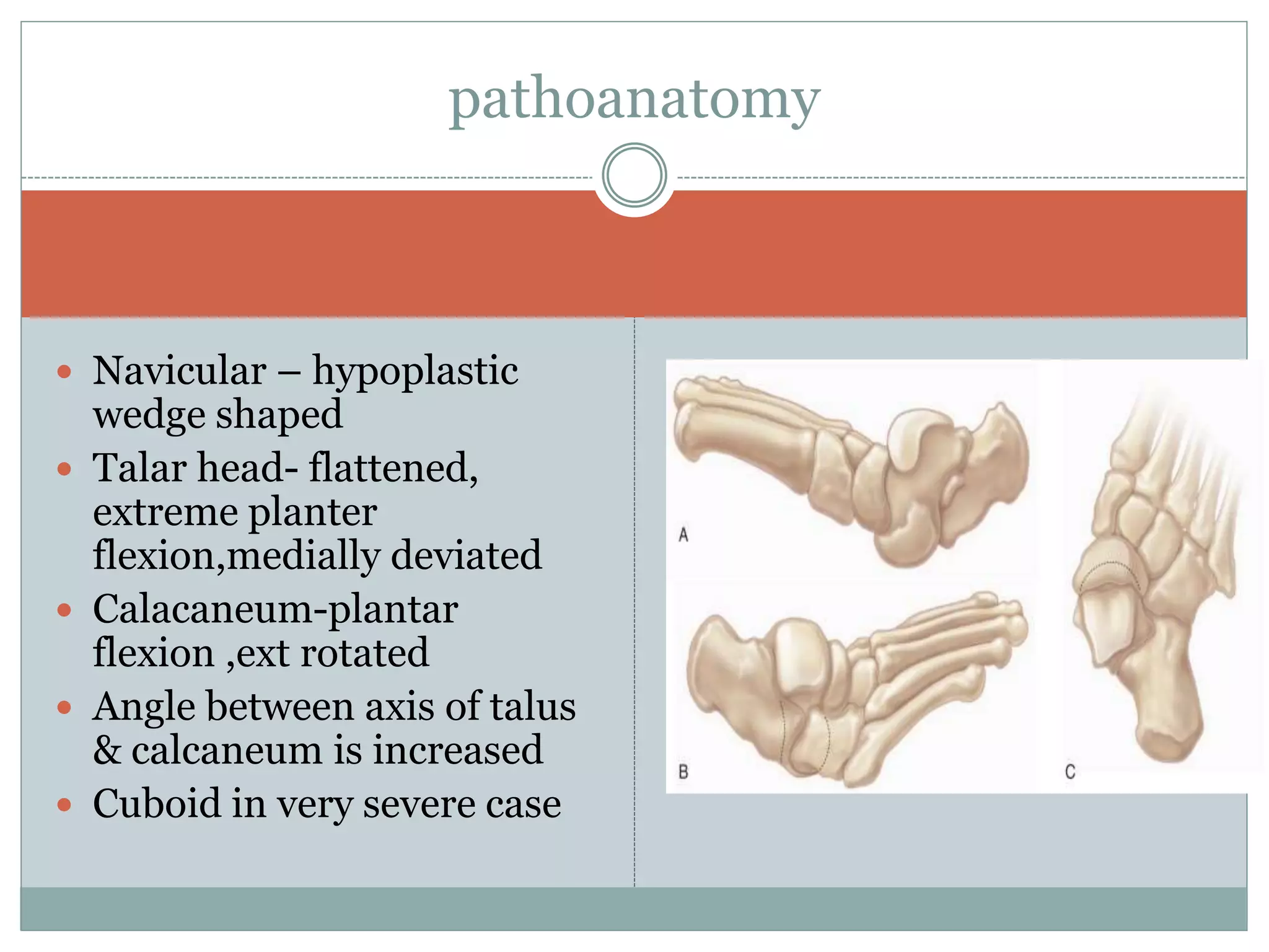 congenital vertical talus by DR.Girish motwani | PPTX | Death, Injury ...